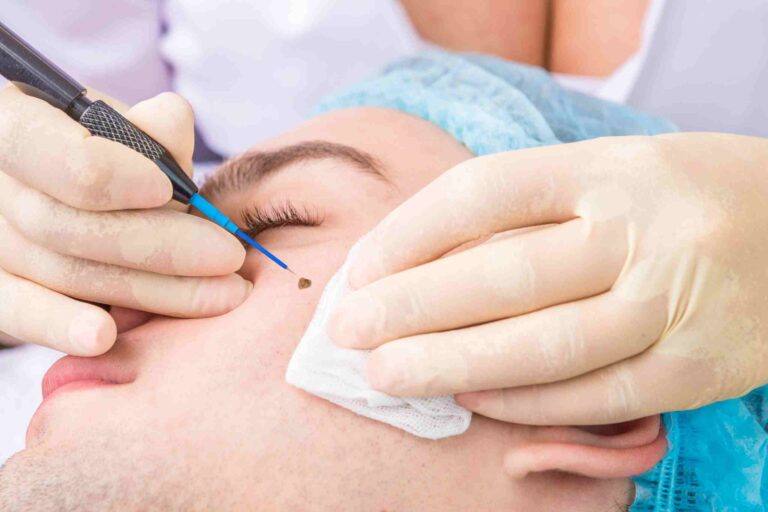 How to remove moles: Is it safe to remove mole? - Get Joys